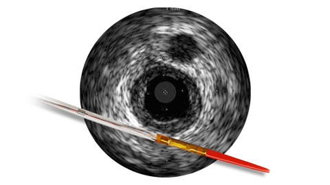 IVUS - Intravascular Ultrasound | Philips Healthcare