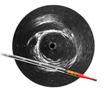 Peripheral IVUS - Intravascular Ultrasound | Philips Healthcare