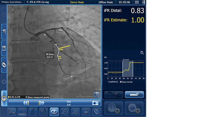 iFR modality | Philips